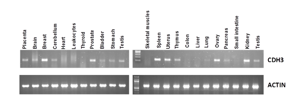 Oncoscience | P-Cadherin (CDH3) is overexpressed in colorectal tumors ...